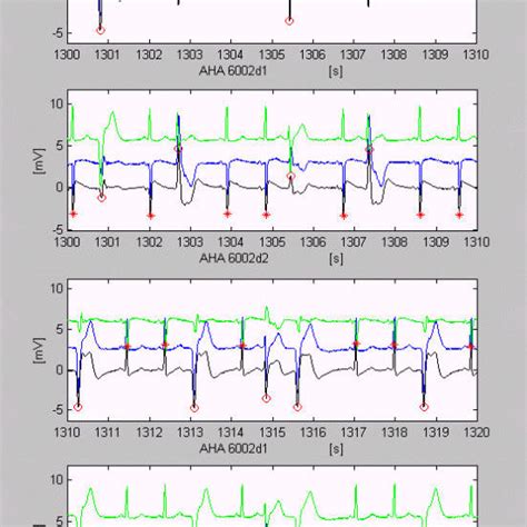 examples of vb detection correctly identified normal qrs complexes and download scientific