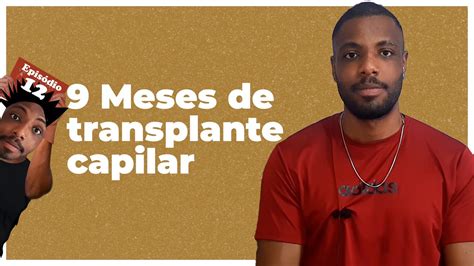 12 O melhor mês de resultado do Transplante Capilar YouTube