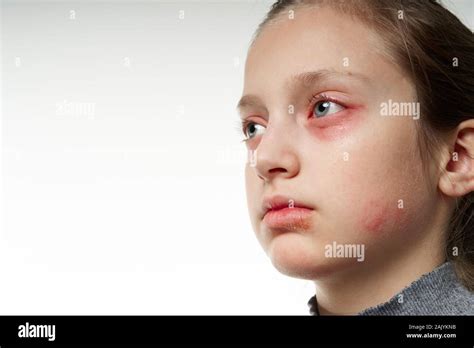 Allergic Reaction Skin Rash Close View Portrait Of A Girls Face Redness And Inflammation Of