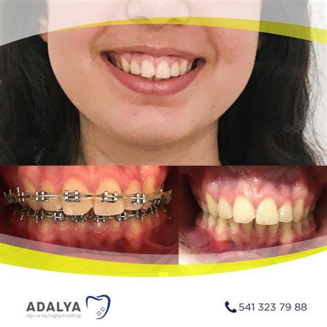 Ortodonti Antalya Diş Teli Tedavisi Şeffaf Plak İnvisalign Tedavisi