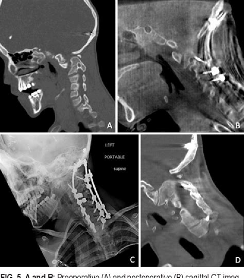 Figure 5 From Surgical Management Of Atlantoaxial Dislocation And