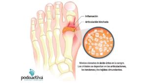 Enfermedad de la gota Síntomas causas y tratamientos