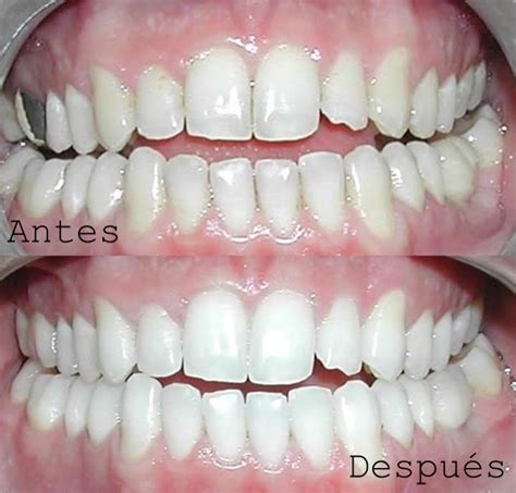 Diseño de Sonrisas Clínica Dental DentArt Las Condes Providencia