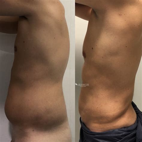 Liposucción de Alta Definición en Madrid Dr Edgar Quintero