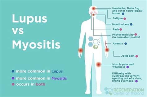 Stem Cell Therapy For Inclusion Body Myositis Autoimmune Ibm