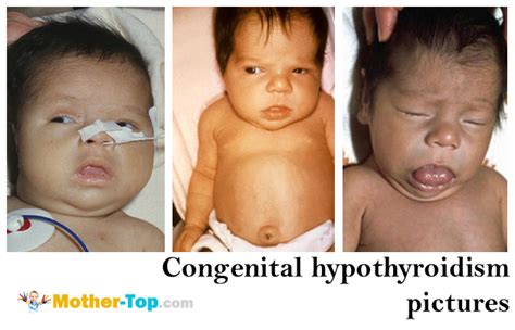 Congenital Hypothyroidism Possible Causes