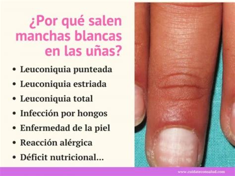 Manchas Blancas en las Uñas de los Pies y Manos