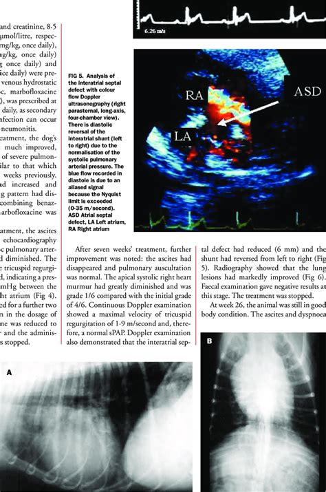 Analysis Of The Tricuspid Regurgitation Systolic Flow Five Weeks After