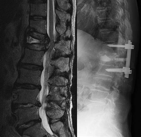 Anterior Decompression And Strut Graft Versus Posterior Decompression