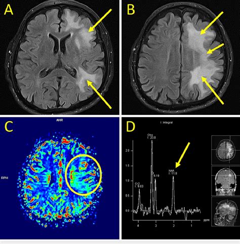 Key Images From MRI Brain With And Without Contrast Perfusion Imaging