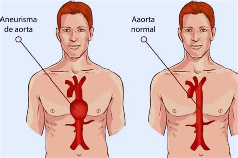 Aneurisma de aorta Causas síntomas y tratamientos