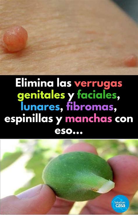 Elimina Las Verrugas Genitales Y Faciales Lunares Fibromas