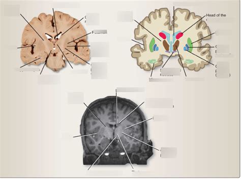 Basal Ganglia Coronal Cross Section Diagram Quizlet