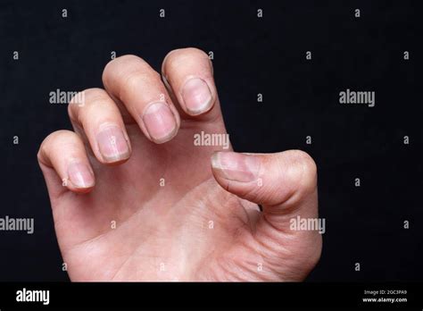 Primer plano de la mano caucásica femenina con uñas quebradizas sucias