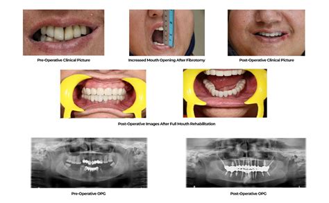 Functional Rehabilitation Using Single Piece Basal Implants In A