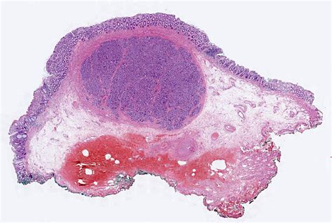 Pathology Outlines Neuroendocrine Tumor