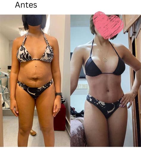 Lipoescultura HD retirada de hérnia umbilical correção da diástase e