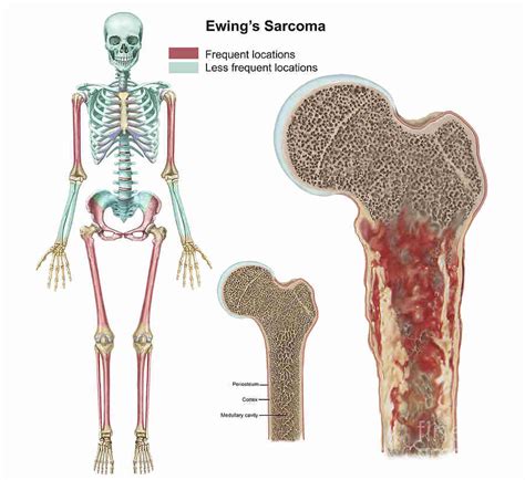 SARCOMA DE EWING Cirugia De Columna En Matamoros