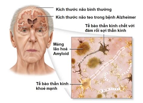 Bệnh mất trí nhớ Alzheimer Nguyên nhân triệu chứng và giải pháp