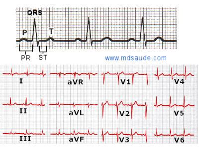 Entenda os resultados do seu eletrocardiograma ECG MD Saúde