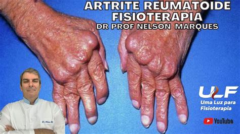 Tratamento De Artrite Reumatoide Fisioterapia