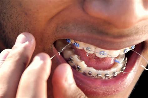 Qué Hacer cuando se rompe un Bracket Veracruz Dental