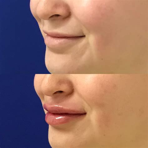 Restylane Kysse Lips Before And After Lipstutorial Org