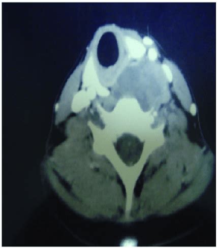 CT Scan Of Neck Axial View Showing A Large Mass Involving The Left
