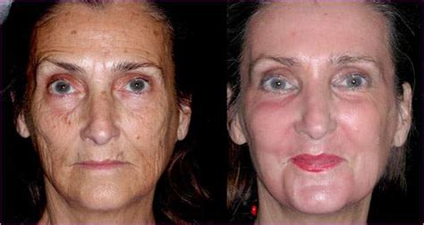 Peeling De Fenol Pre O Indica O E Fotos Antes E Depois Educar Sa De