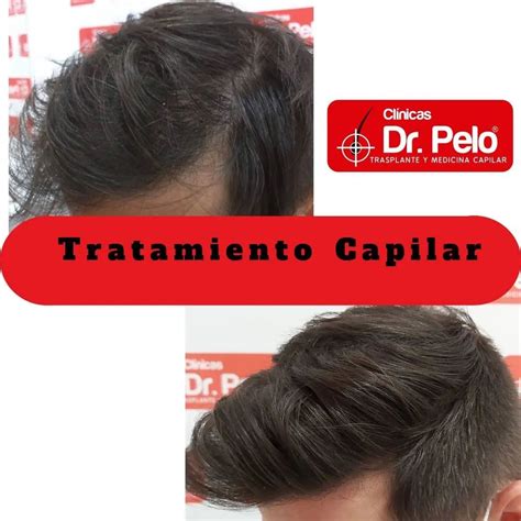 Injerto Capilar Medicina Y Trasplante Capilar Clinicas Dr Pelo