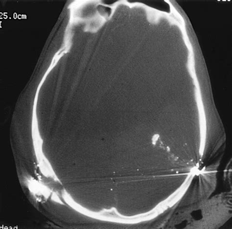 Gunshot Injuries What Does A Radiologist Need To Know RadioGraphics