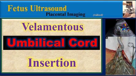 Fetus Ultrasound Velamentous Umbilical Cord Insertion Youtube
