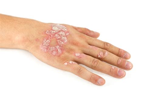 Psoriazis în imagini Tipuri cauze simptome și tratament Sănătate