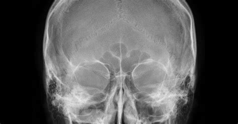 Medical Dentix Radiografía cefalométrica Frontal