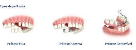 Tipos de Prótese Dentária Fixa Total Adesiva e Flexível