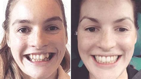 How Braces Change Face Shape Before After