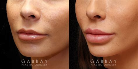 Lips Plastic Surgery Before And After Lipstutorial Org