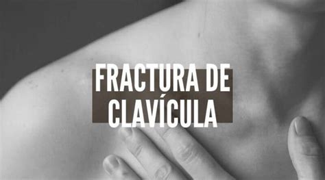 Cuánto tiempo tarda en curarse una fractura de clavícula JL FISIOS