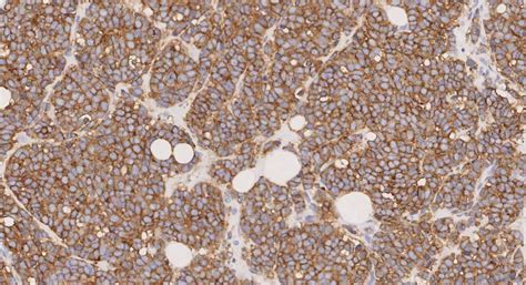 Merkle Cell Carcinoma Ottawa Atlas Of Pathology