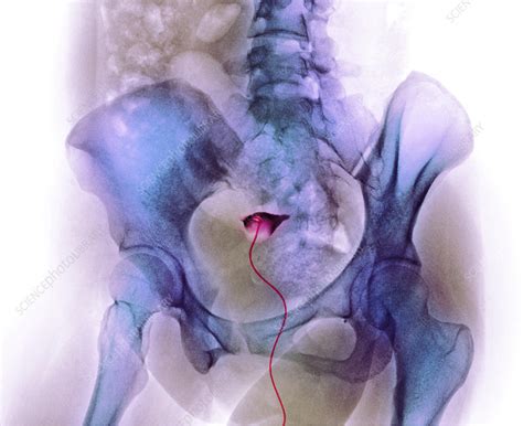 Blocked Fallopian Tube X Ray Stock Image F037 8142 Science Photo