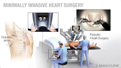 Mayo Clinic Q And A Mitral Valve Repair With Minimally Invasive Heart