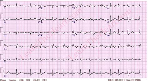 Right Bundle Branch Block Ecg Example Learn The Heart