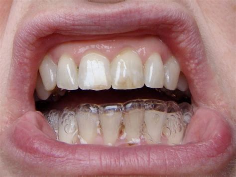 Use A Permanent Retainer Retainers Permanent Retainer