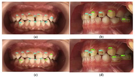 applied sciences free full text deep learning application in dental caries detection using