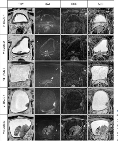 Figure From Accuracy Of Vesical Imaging Reporting And Data System For