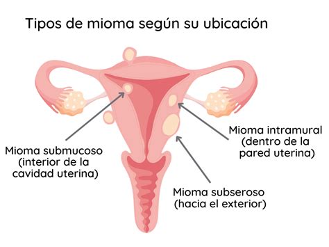 Pueden Afectar Los Miomas A La Fertilidad