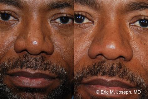 Eric M Joseph MD Permanent Non Surgical Rhinoplasty Before After