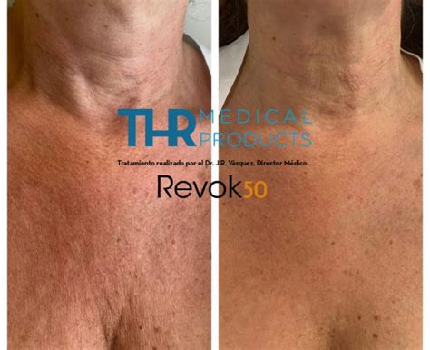 Revitaliza tu Piel con Revok50 El Secreto de la Bioestimulación