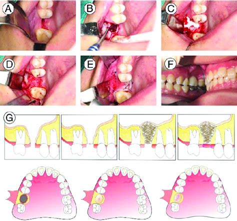 Procedure For The Transalveolar Approach A OAF B Separate The