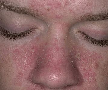 Seborrheic Dermatitis Face Women